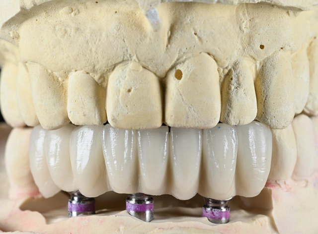 PFM Bridge (Co-Cr): dentallabgs