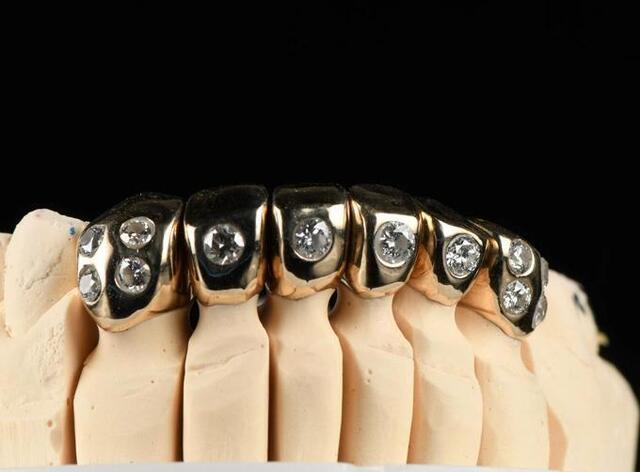 Full Metal Cast Crown (Yellow Gold with Diamonds): dentallabgs
